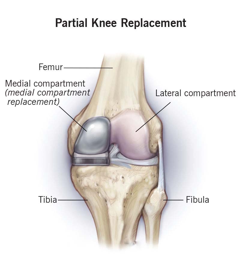 Partial Knee Replacement Dr Akshay Shetty Orthopaedics Partial Knee Replacement Dr Akshay Shetty Orthopaedics