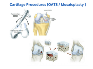 Cartilage_Procedures - Dr. Akshay Shetty Orthopaedics Cartilage Procedures