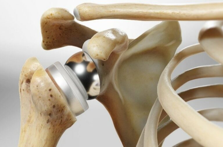 Reverse_Shoulder_Arthroplasty - Dr. Akshay Shetty Orthopaedics