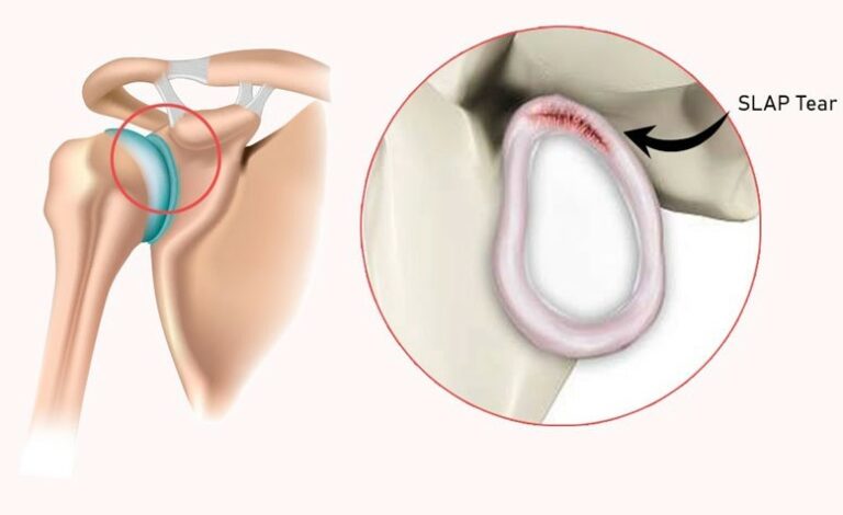 SLAP_Repair - Dr. Akshay Shetty Orthopaedics